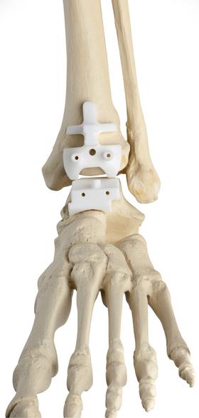 Wright's PROPHECY® INBONE® Pre-Op Guides For Ankle Replacement At AAOS ...