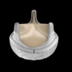 Small Incision Aortic Valve Replacement: Promising Data From Edwards ...