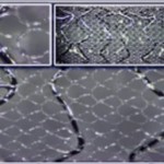 MGuard™ Embolic Protection Stent: Study Enrollment Complete - Medlatest ...