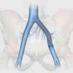 Cook's Zilver Vena™ Venous Stent Expands Into Canada - Medlatest ...