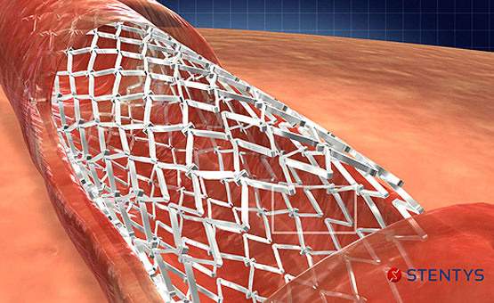 Mind The Gap: New Study Suggests Self-Apposing® Stents Completely ...