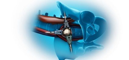 L5/S1 Lateral Disc Access with New OLIF51 System - Medlatest - Medical ...