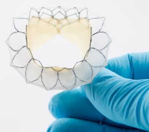 Successful First Human Implant of Neovasc Tiara™ Transcatheter Mitral ...