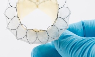 Successful First Human Implant of Neovasc Tiara™ Transcatheter Mitral ...