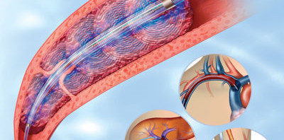 U.S. FDA Clears EkoSonic® Endovascular System for Treatment of ...