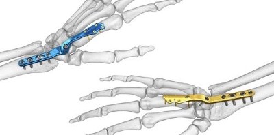 Acumed® Launches Total Wrist Fusion Plating System for Post-Traumatic ...