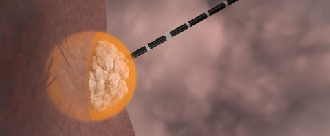 Covidien Targets Accurate Liver Tumor Ablation with Emprint™ System ...