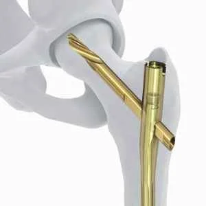 DePuy Synthes Targets Better Hip Fracture Outcomes with New Nailing ...