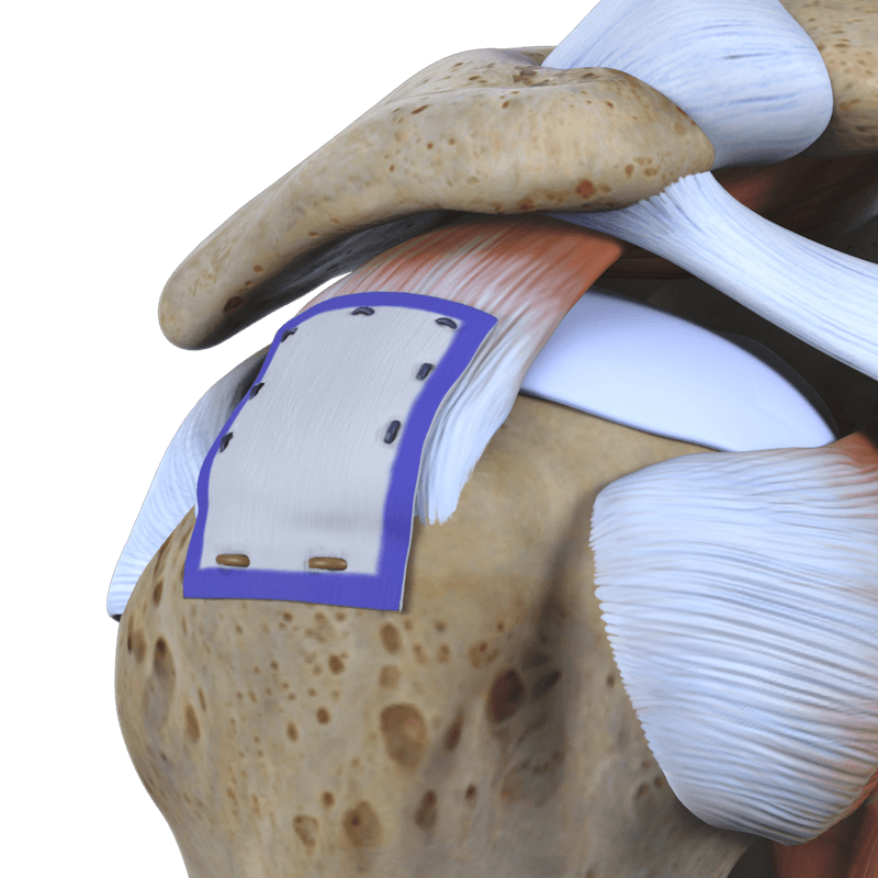 Study Points to Rotator Cuff Healing and No Tear Progression ...