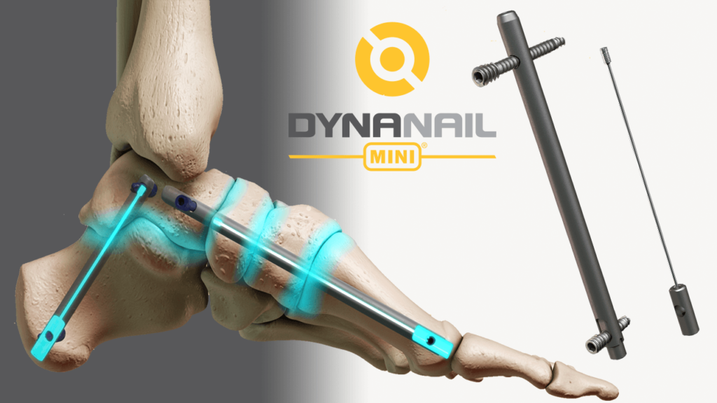 MedShape Launches DynaNail Mini® for Medial Column Fusion - Medlatest ...